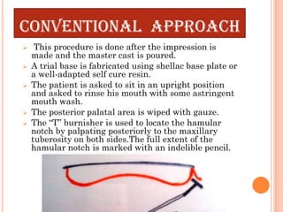 The posterior palatal seal | PPTX