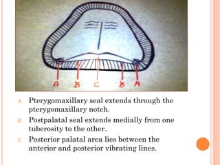 The posterior palatal seal | PPTX