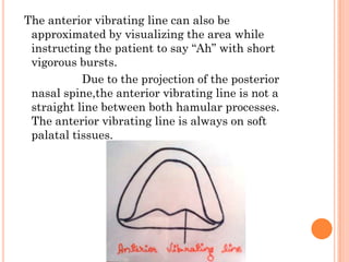 The posterior palatal seal | PPTX