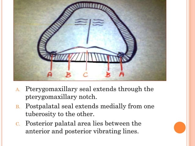 The Posterior Palatal Seal Ppt