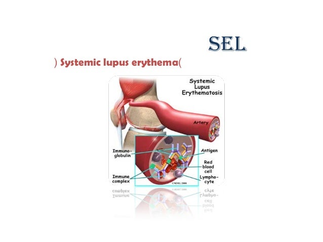 SLE ( Systemic lupus erythema)