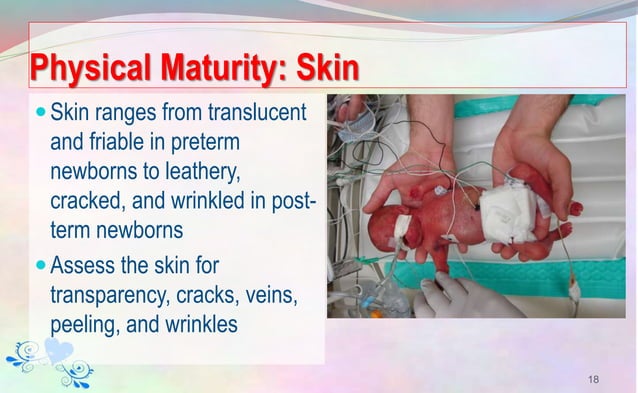 The preterm infant | PPTX