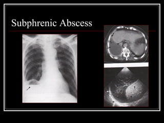 The problem of upper abdominal pain | PPT | Death, Injury, or Military ...