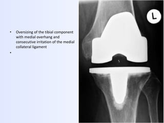 The problems of over or undersizing of tkr | PPT