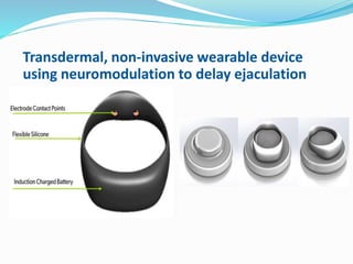 Mechanical Devices for the Treatment of Premature Ejaculation | PPT ...