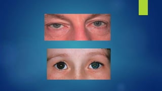 The pupil and it’s abnormalities | PPTX