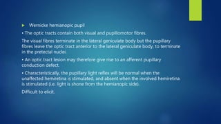The pupil and it’s abnormalities | PPTX