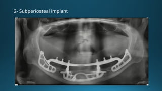 the radiographia appearance of different dental materials.pptx