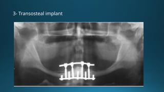 the radiographia appearance of different dental materials.pptx