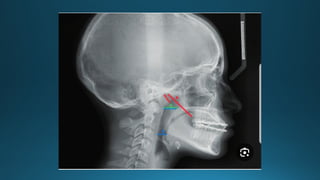 the radiographia appearance of different dental materials.pptx