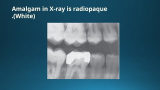 the radiographia appearance of different dental materials.pptx