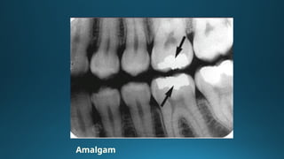 the radiographia appearance of different dental materials.pptx