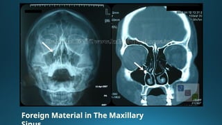 the radiographia appearance of different dental materials.pptx