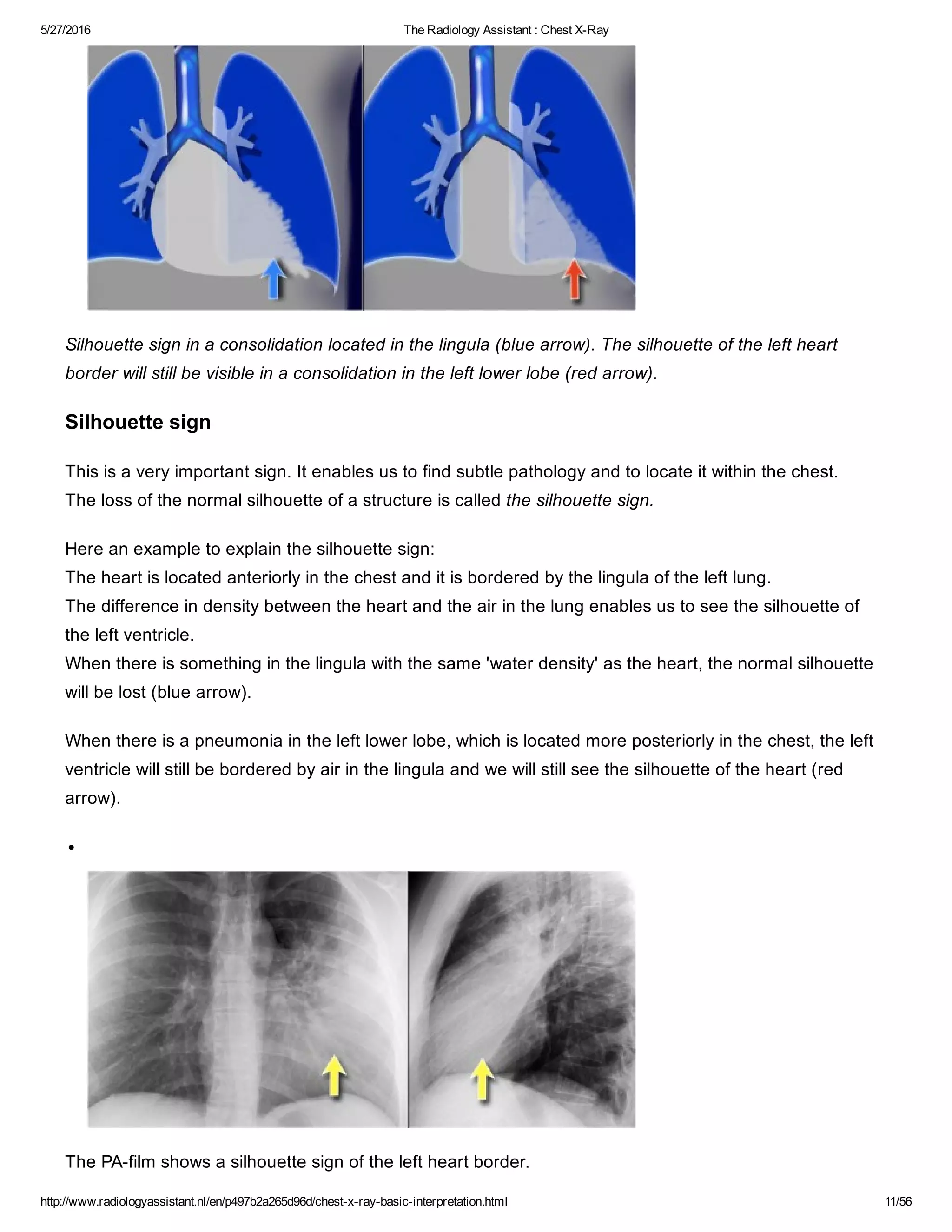 The radiology assistant chest x ray - basic interpretation | PDF