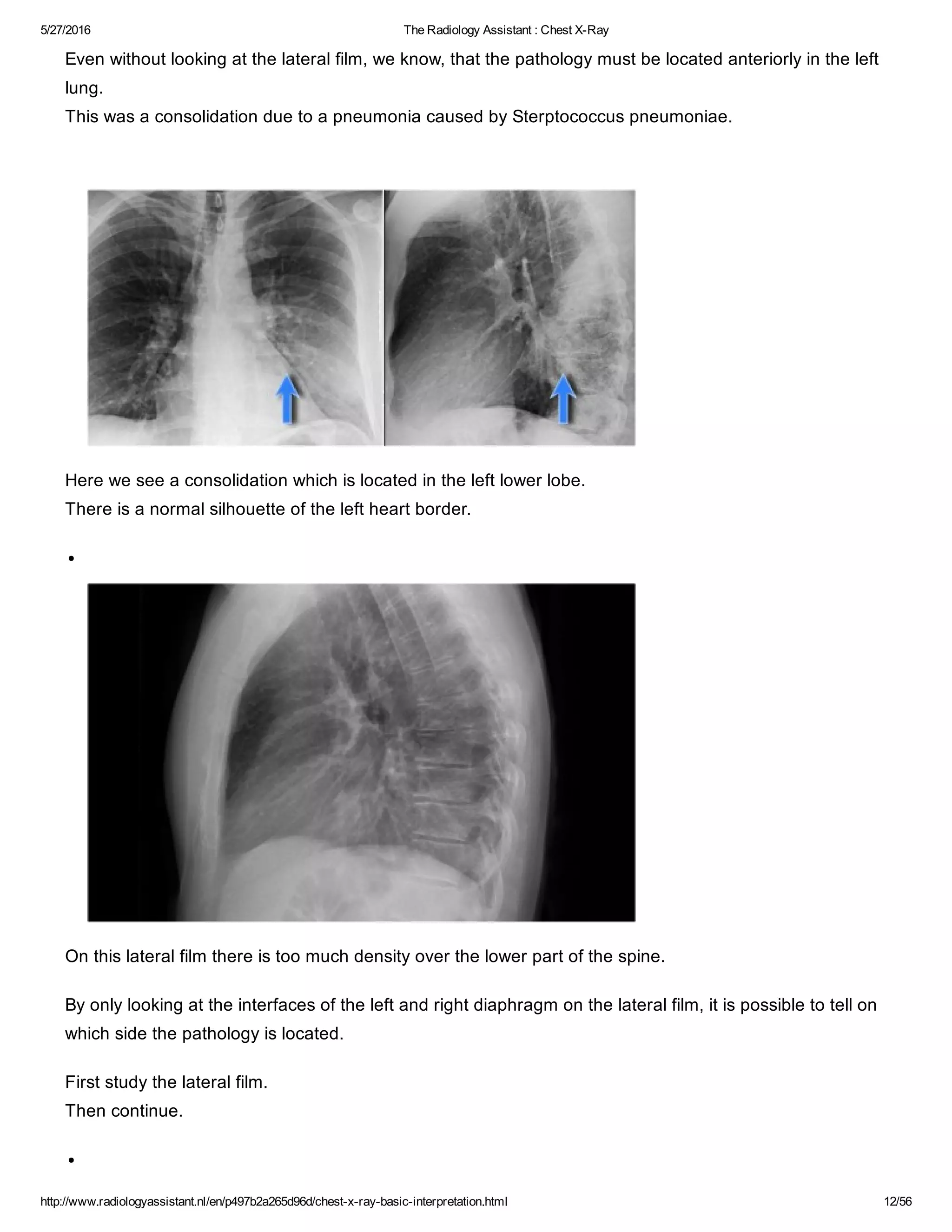 The radiology assistant chest x ray - basic interpretation | PDF