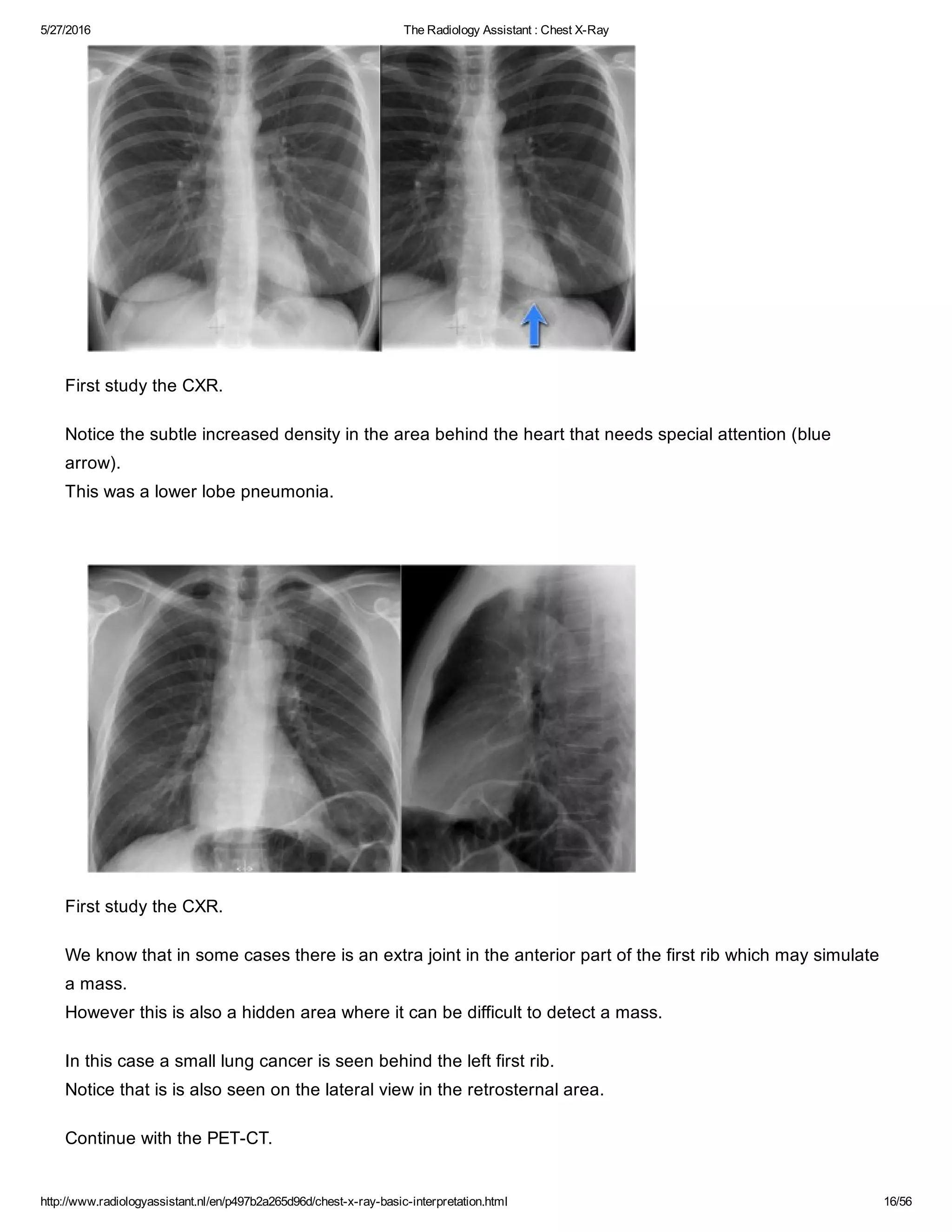 The radiology assistant chest x ray - basic interpretation | PDF
