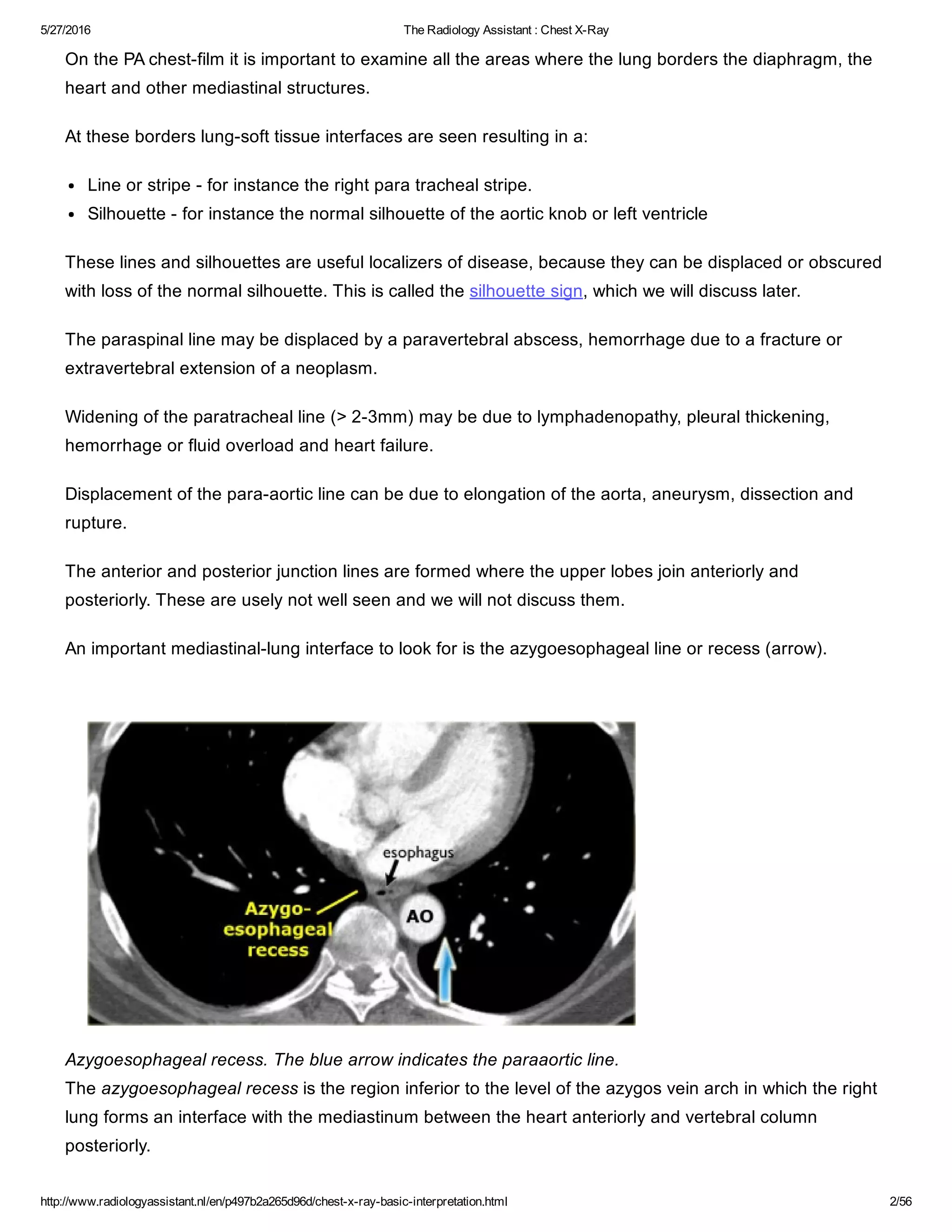 The radiology assistant chest x ray - basic interpretation | PDF