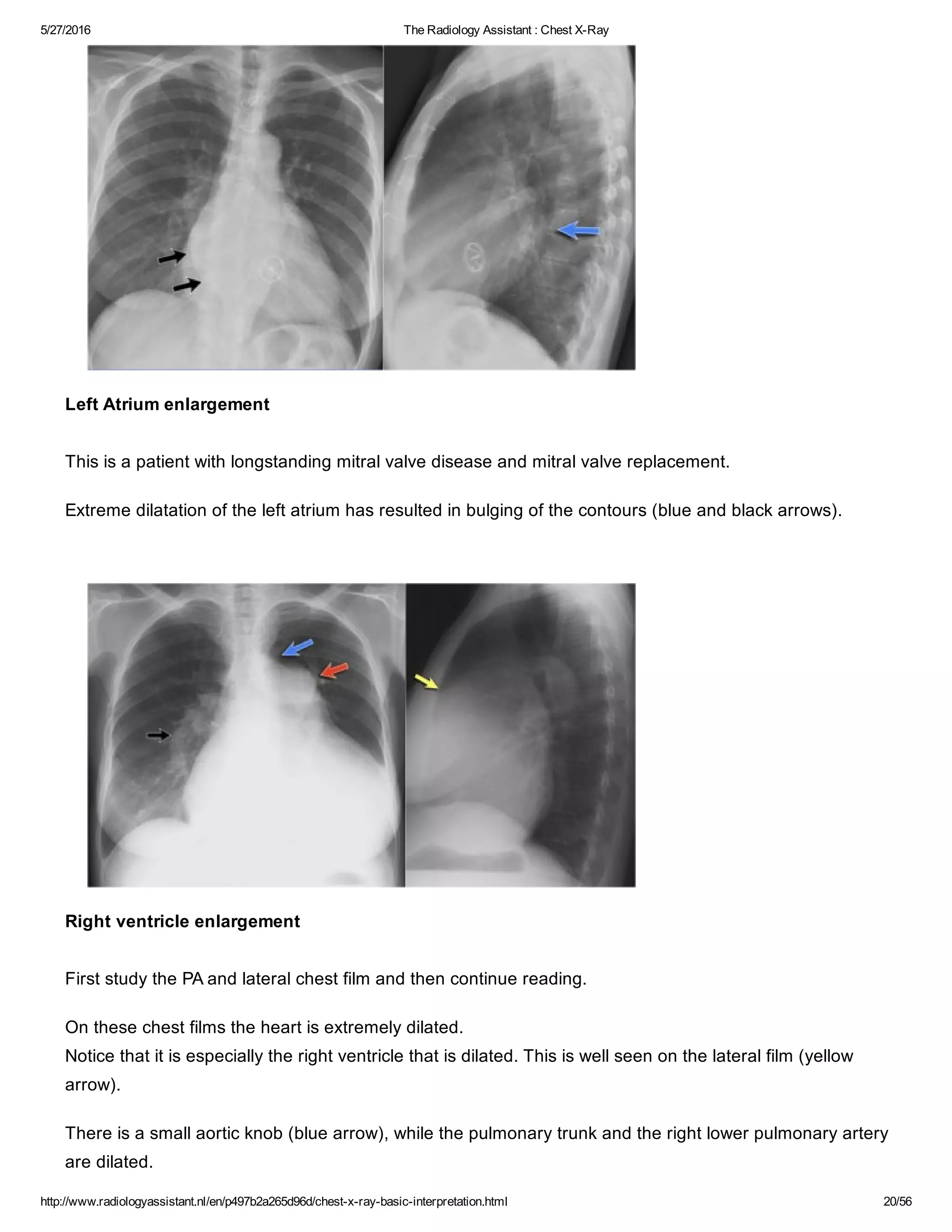 The radiology assistant chest x ray - basic interpretation | PDF