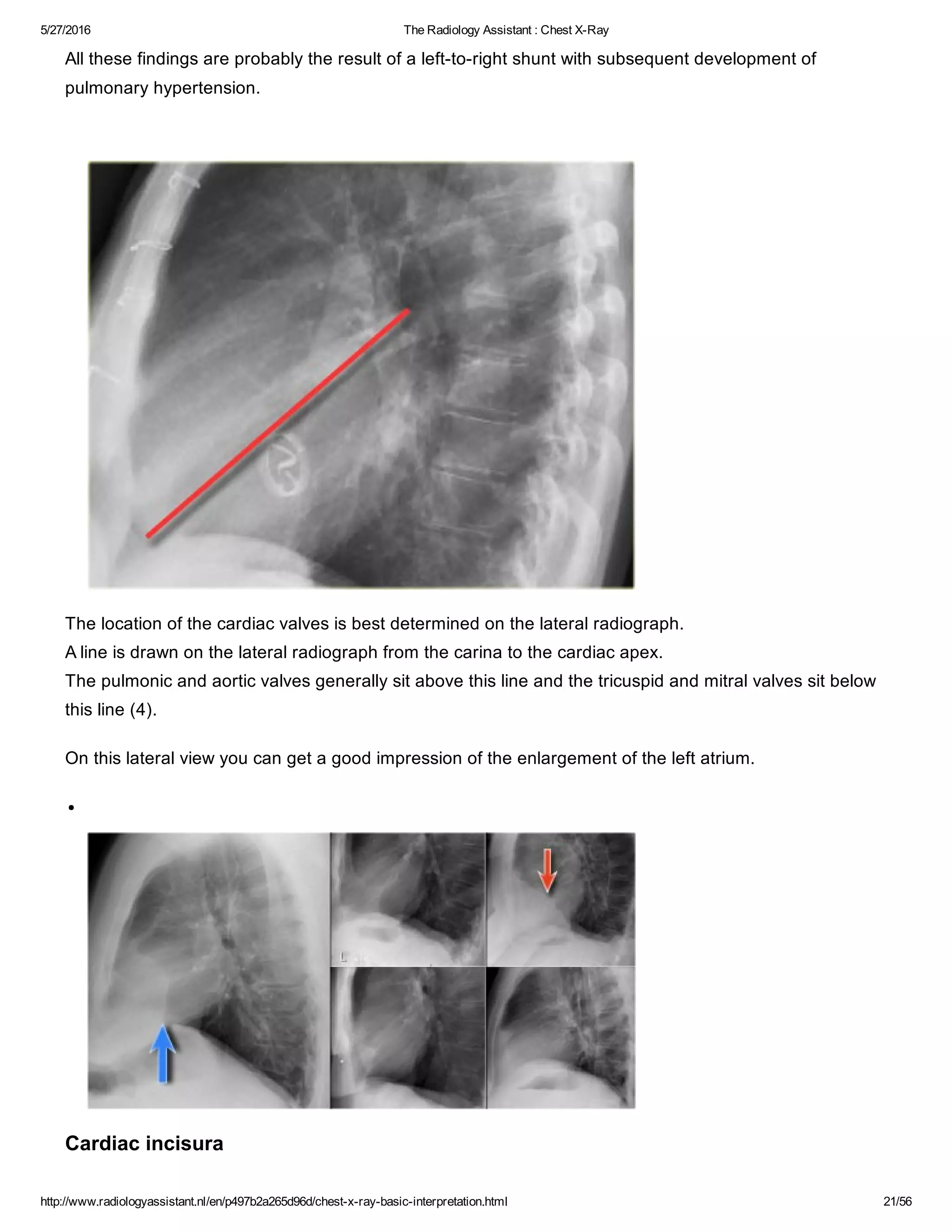 The radiology assistant chest x ray - basic interpretation | PDF