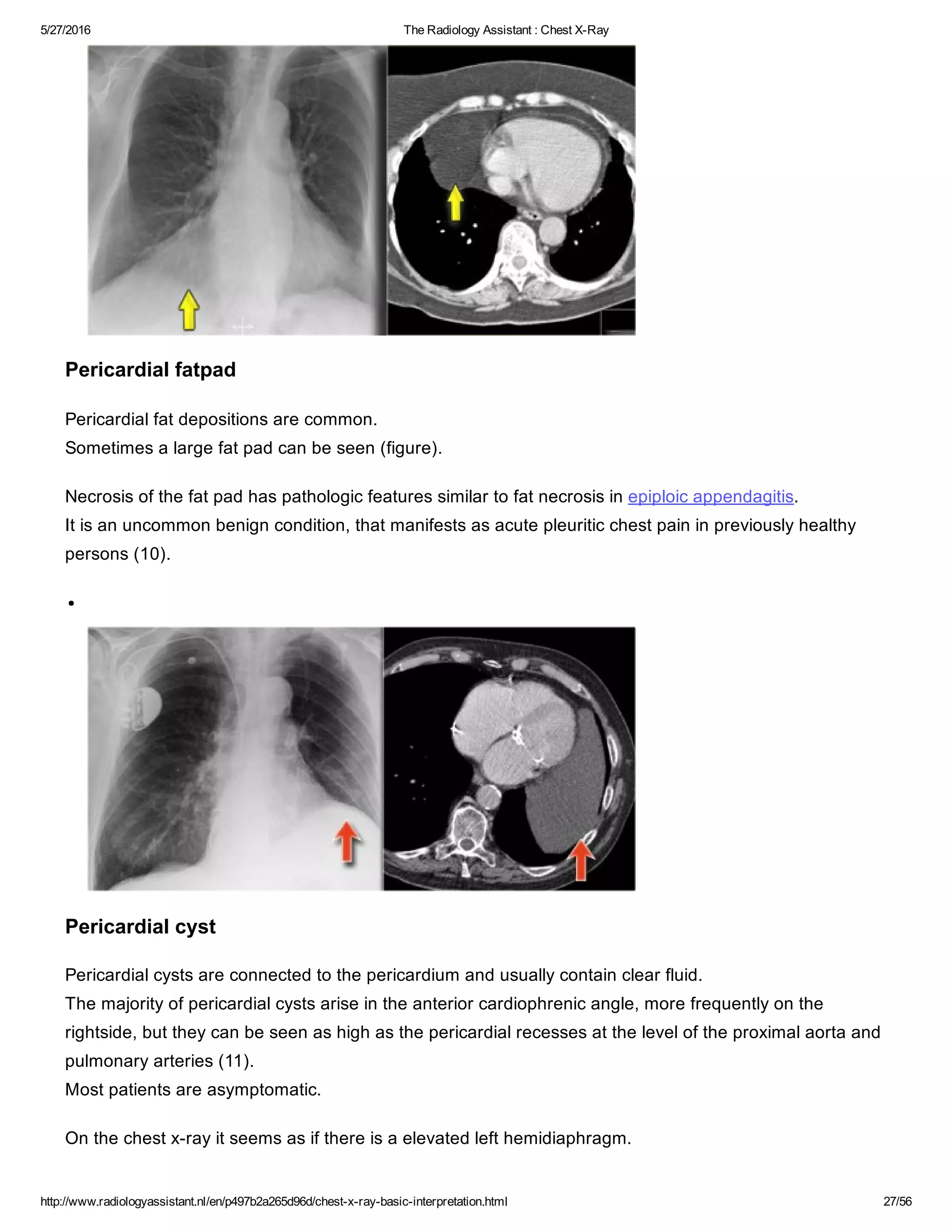 The radiology assistant chest x ray - basic interpretation | PDF