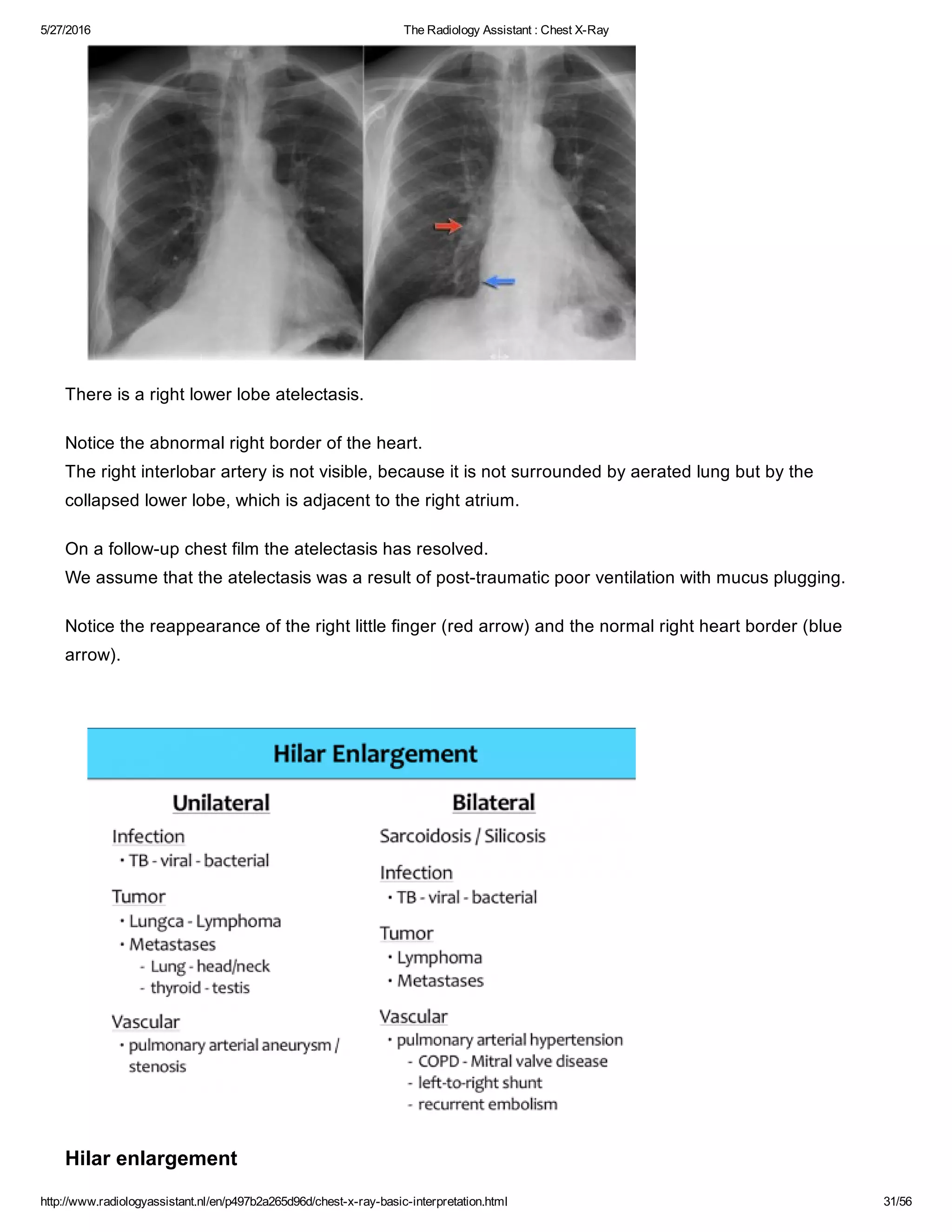 The radiology assistant chest x ray - basic interpretation | PDF