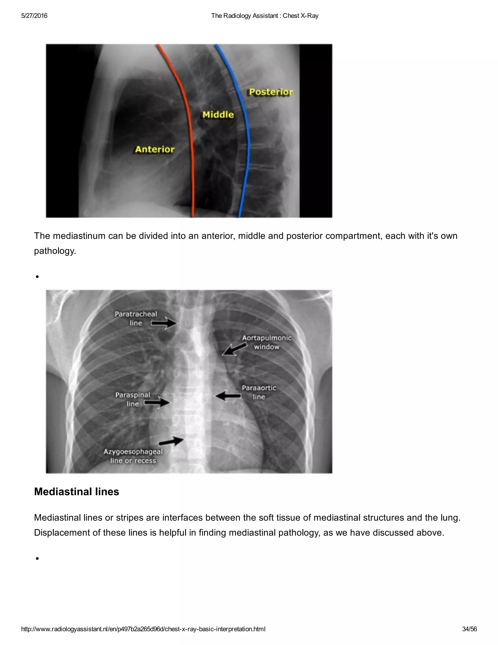 The radiology assistant chest x ray - basic interpretation | PDF
