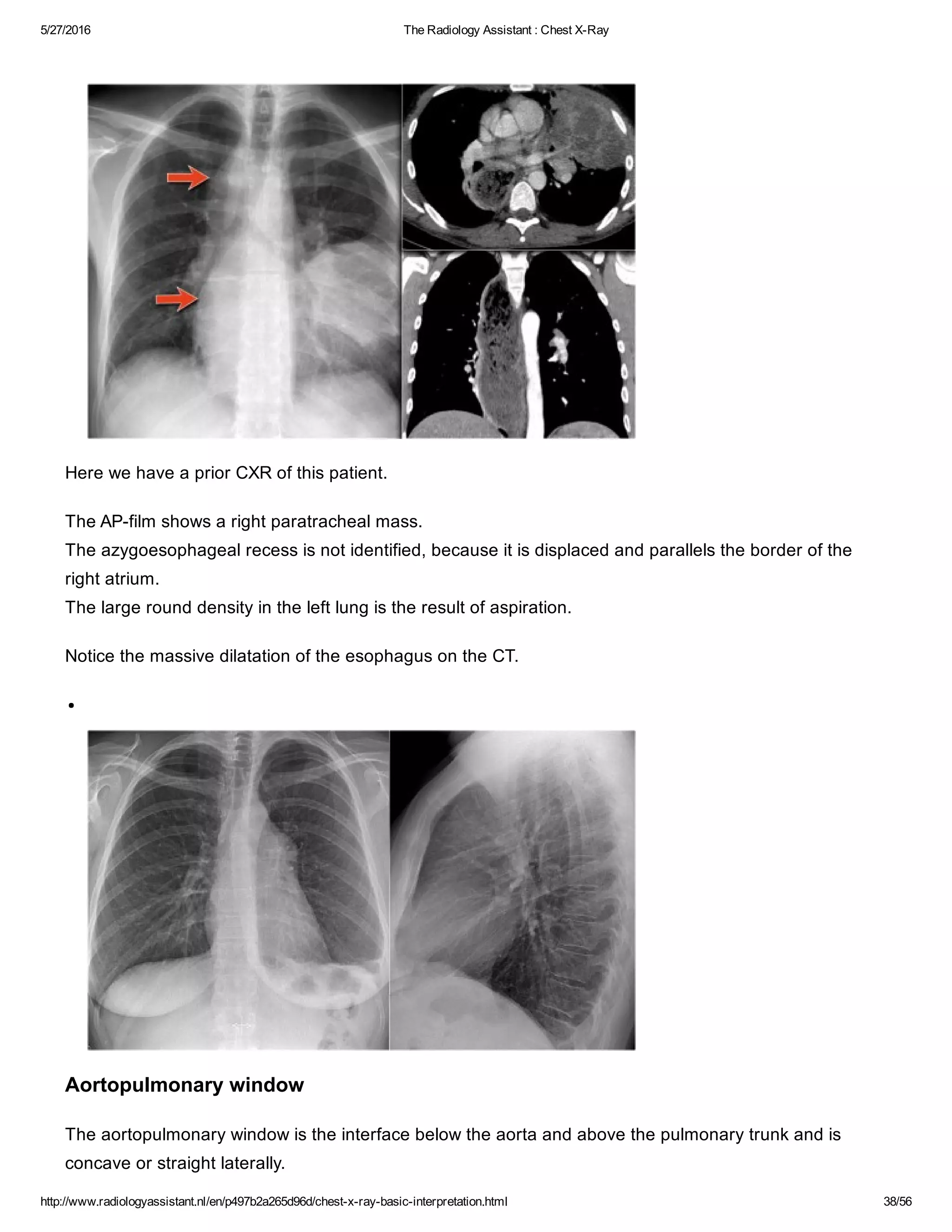 The radiology assistant chest x ray - basic interpretation | PDF