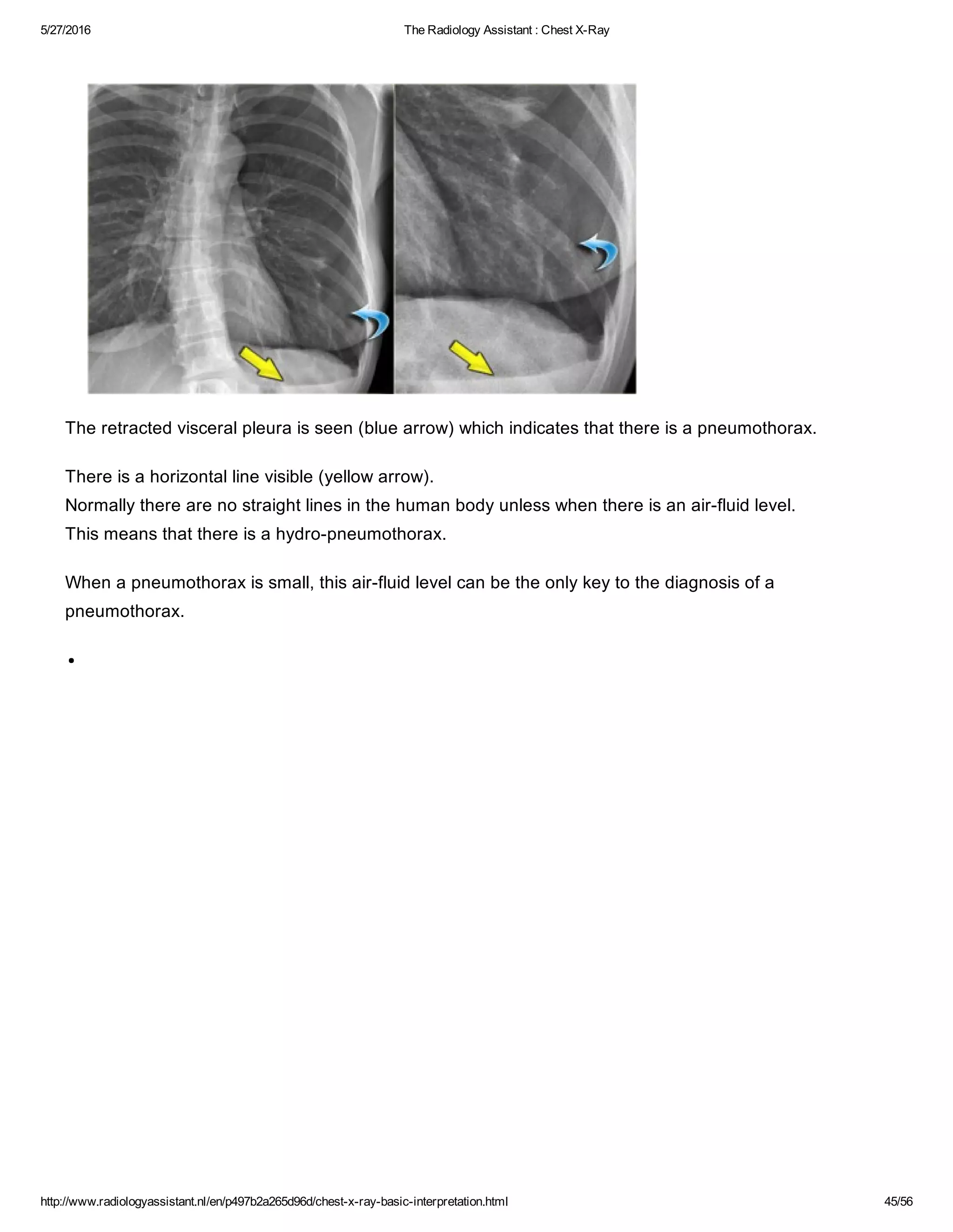 The radiology assistant chest x ray - basic interpretation | PDF