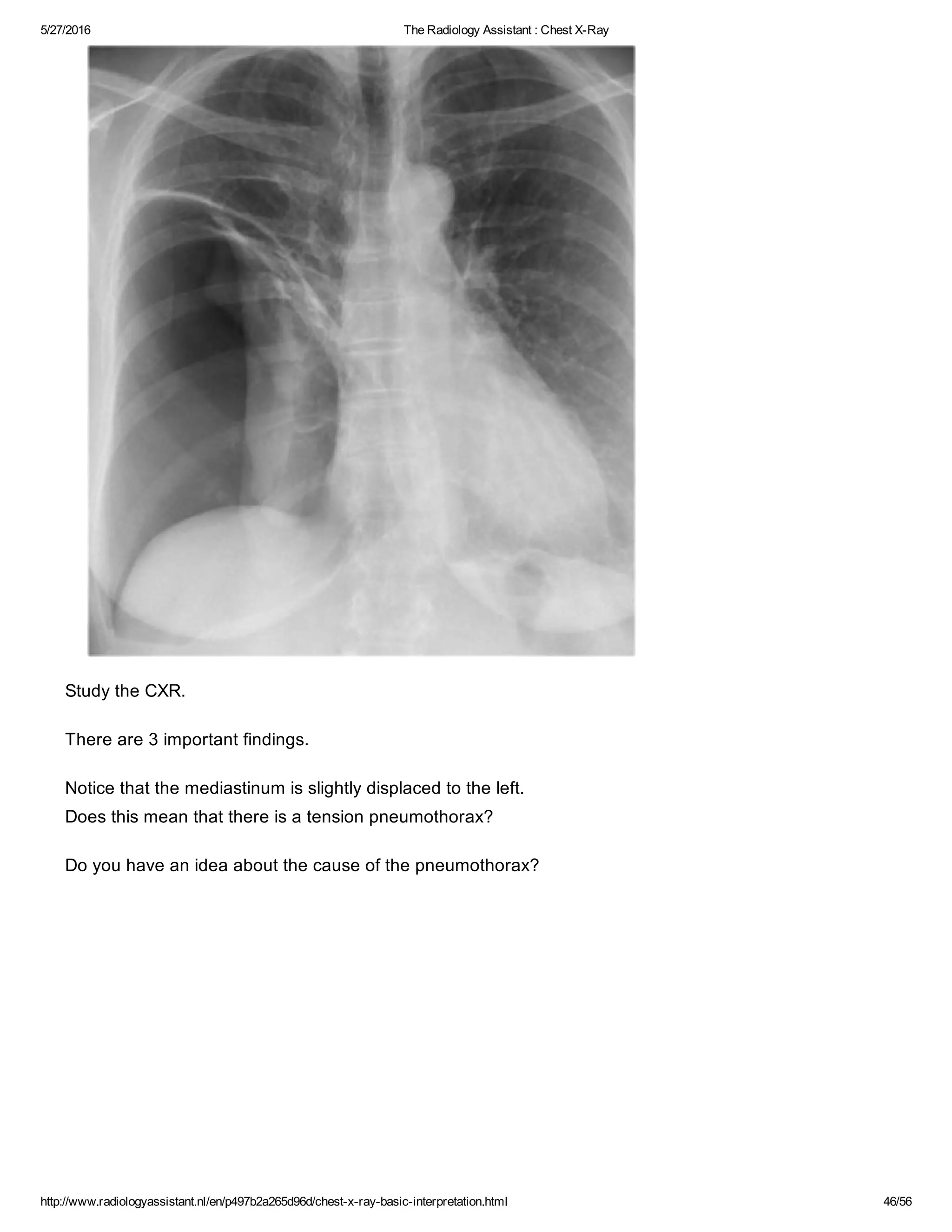The radiology assistant chest x ray - basic interpretation | PDF