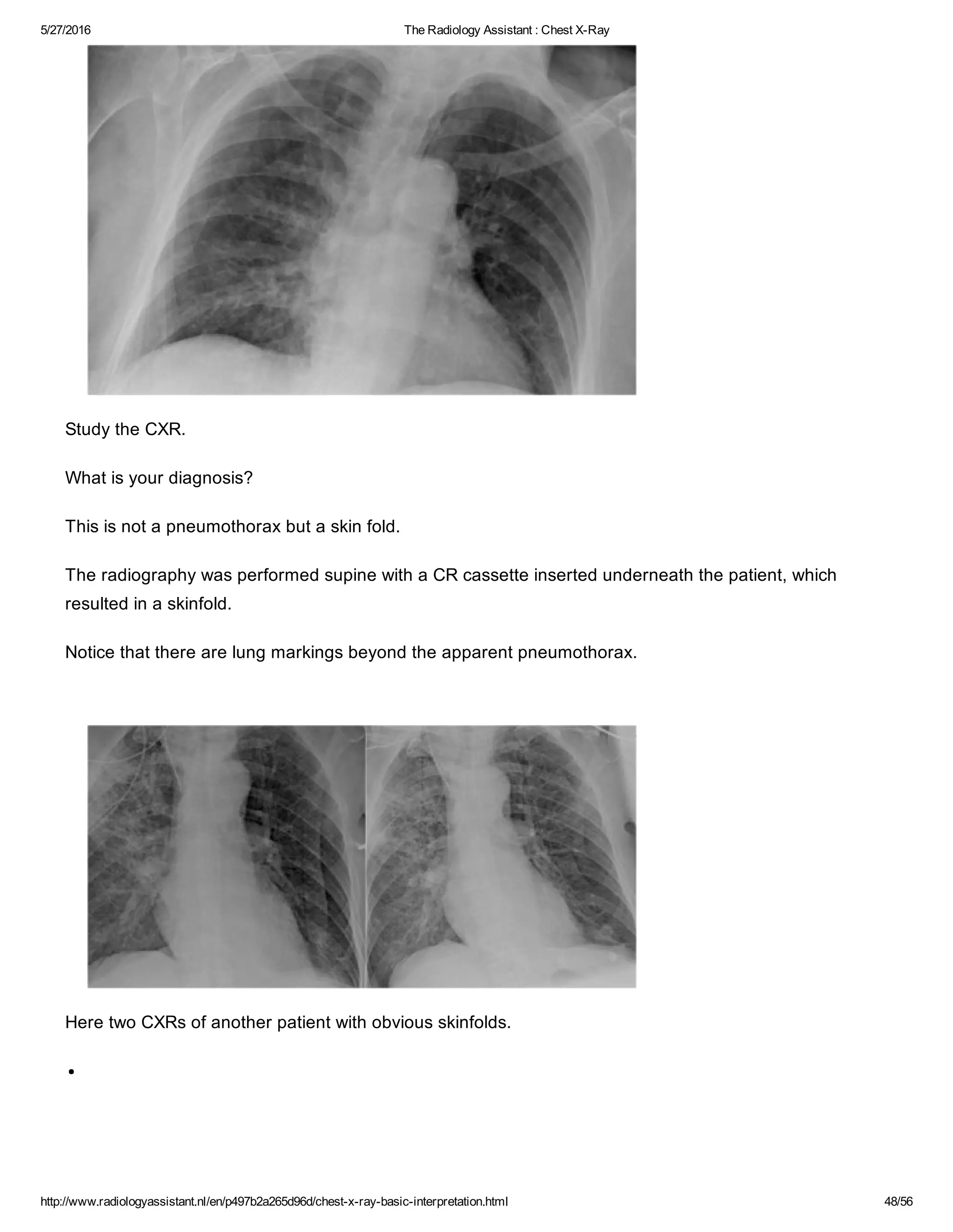 The radiology assistant chest x ray - basic interpretation | PDF