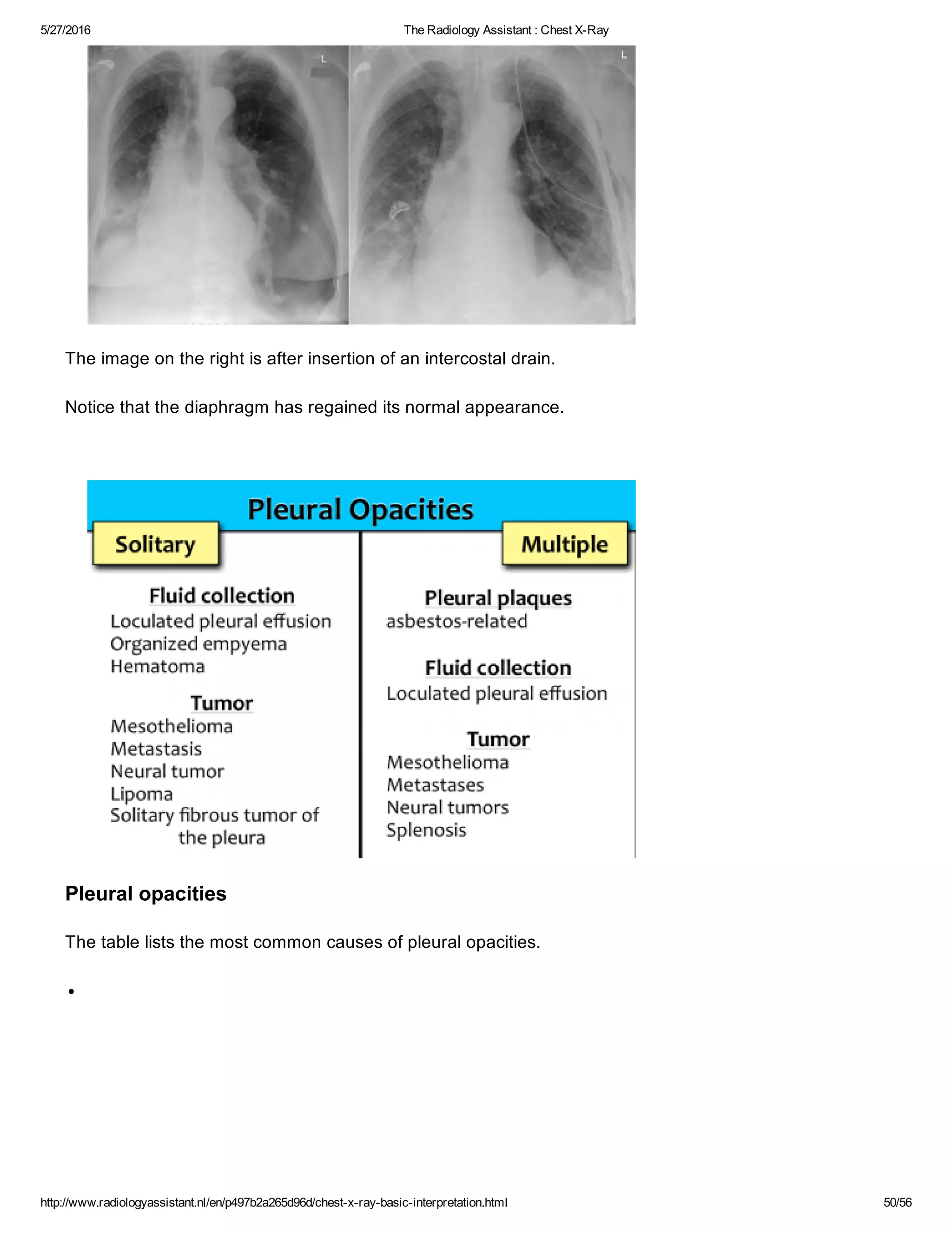 The radiology assistant chest x ray - basic interpretation | PDF