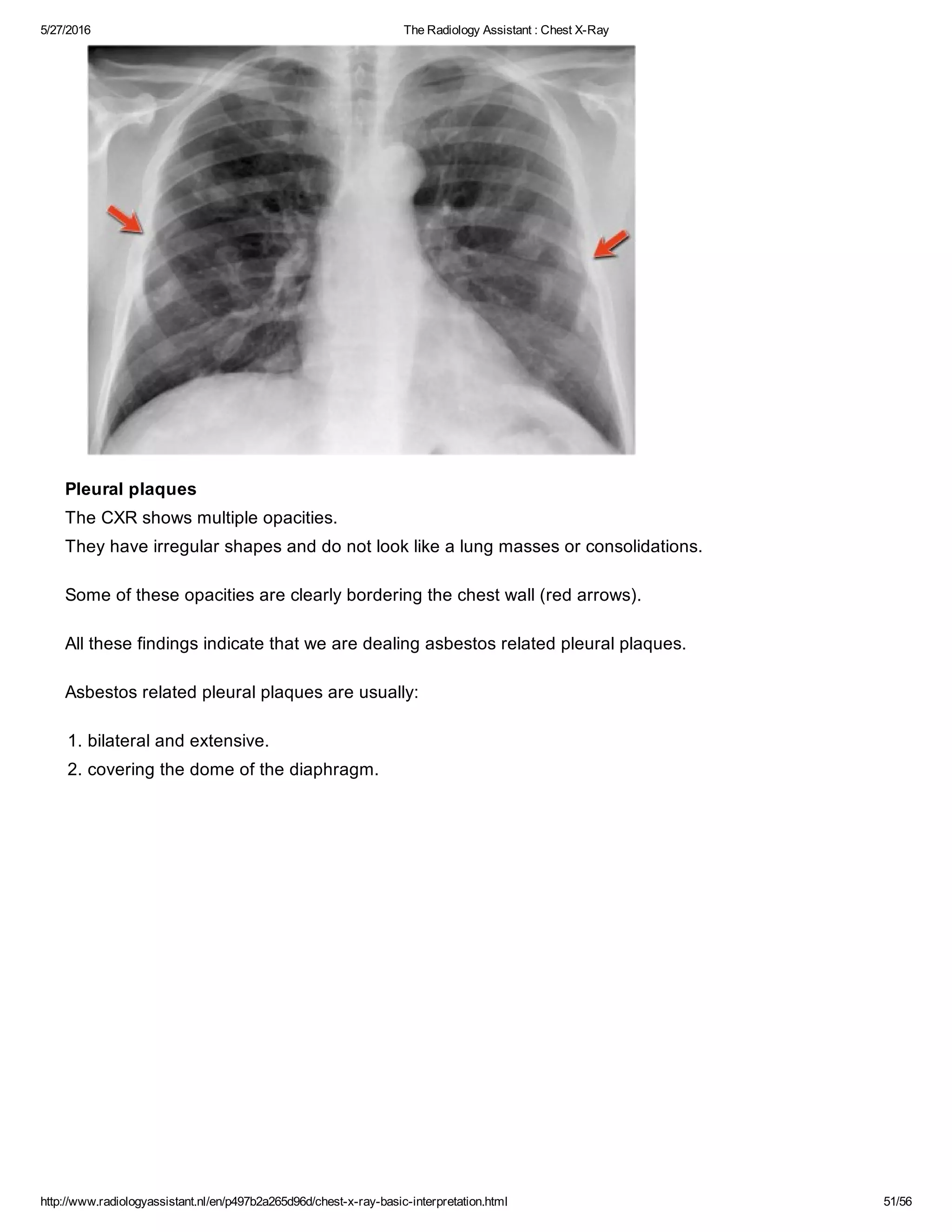 The radiology assistant chest x ray - basic interpretation | PDF