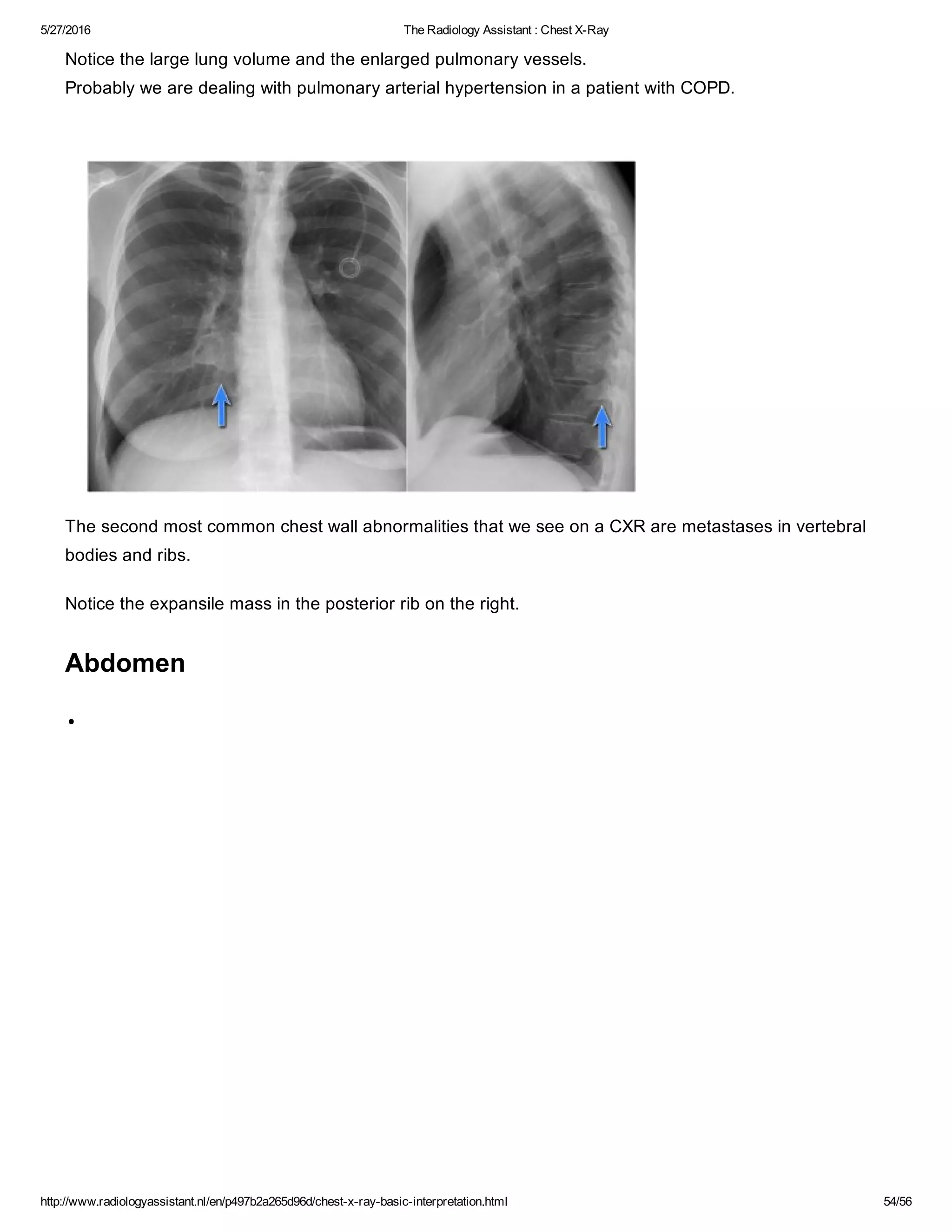 The radiology assistant chest x ray - basic interpretation | PDF