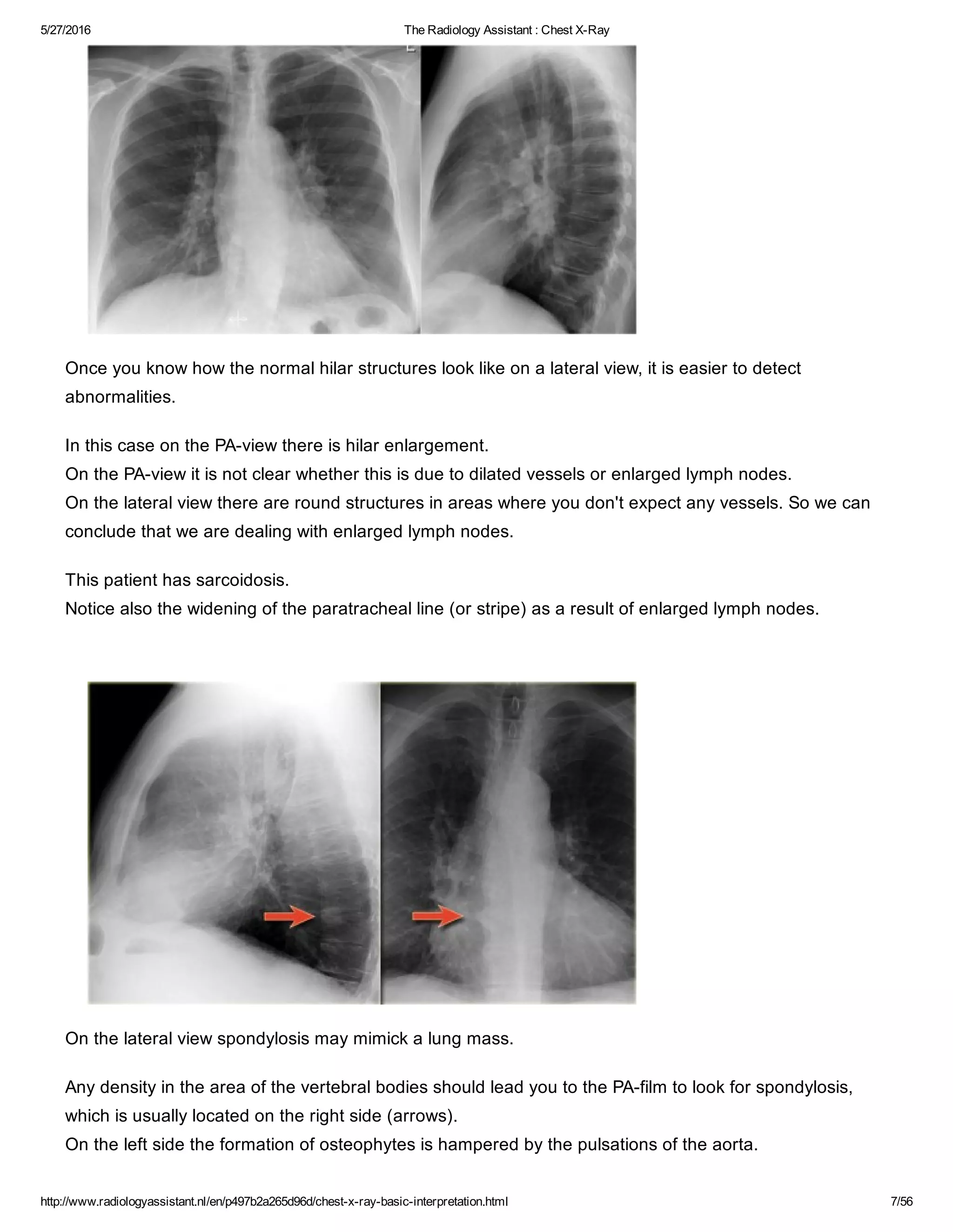 The radiology assistant chest x ray - basic interpretation | PDF