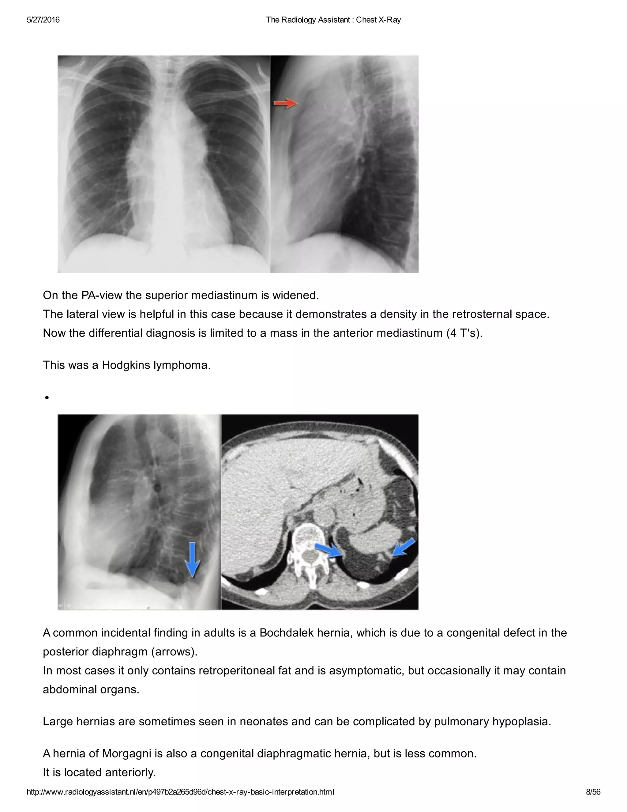 The radiology assistant chest x ray - basic interpretation | PDF