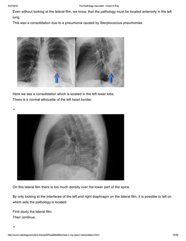 The radiology assistant chest x ray - basic interpretation | PDF