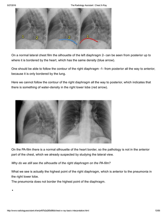 The radiology assistant chest x ray - basic interpretation | PDF