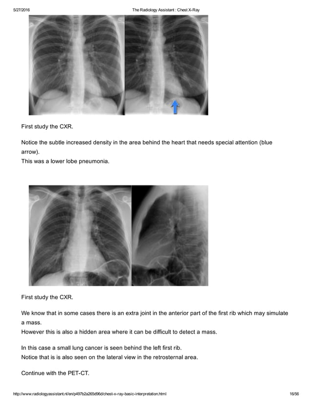 The radiology assistant chest x ray - basic interpretation | PDF
