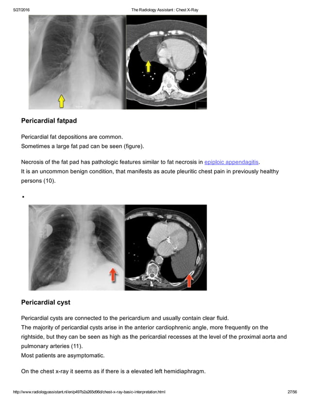 The radiology assistant chest x ray - basic interpretation | PDF
