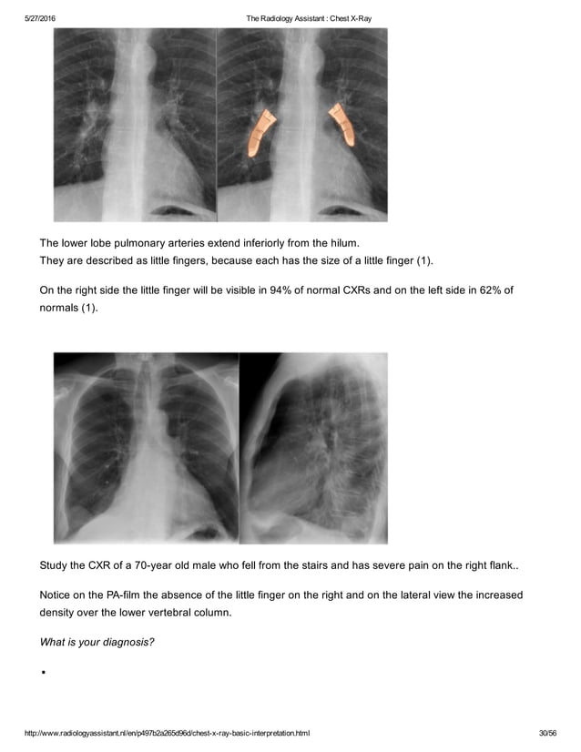 The radiology assistant chest x ray - basic interpretation | PDF