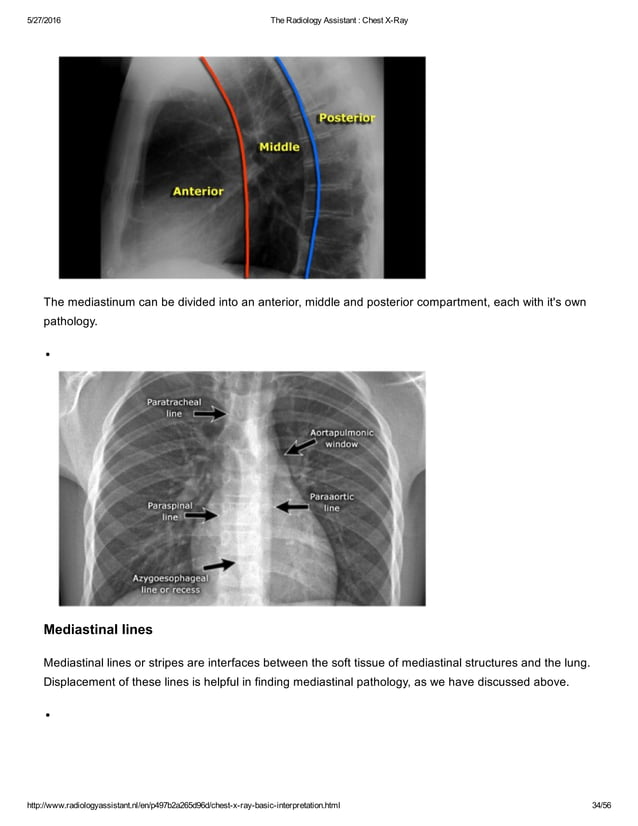 The radiology assistant chest x ray - basic interpretation | PDF