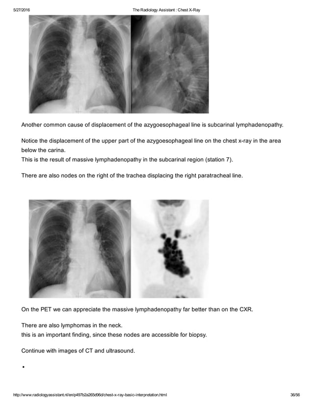The radiology assistant chest x ray - basic interpretation | PDF