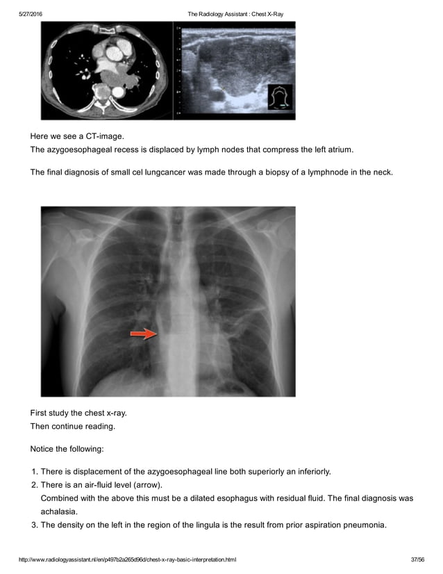 The radiology assistant chest x ray - basic interpretation | PDF