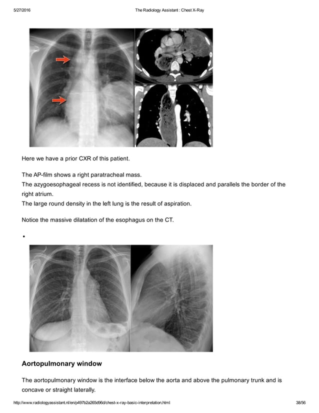 The radiology assistant chest x ray - basic interpretation | PDF