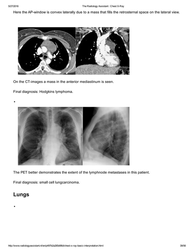 The radiology assistant chest x ray - basic interpretation | PDF