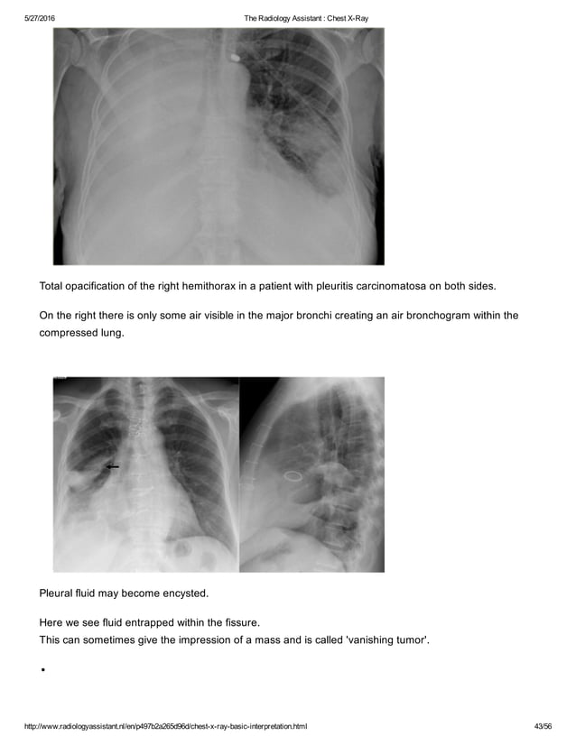 The radiology assistant chest x ray - basic interpretation | PDF