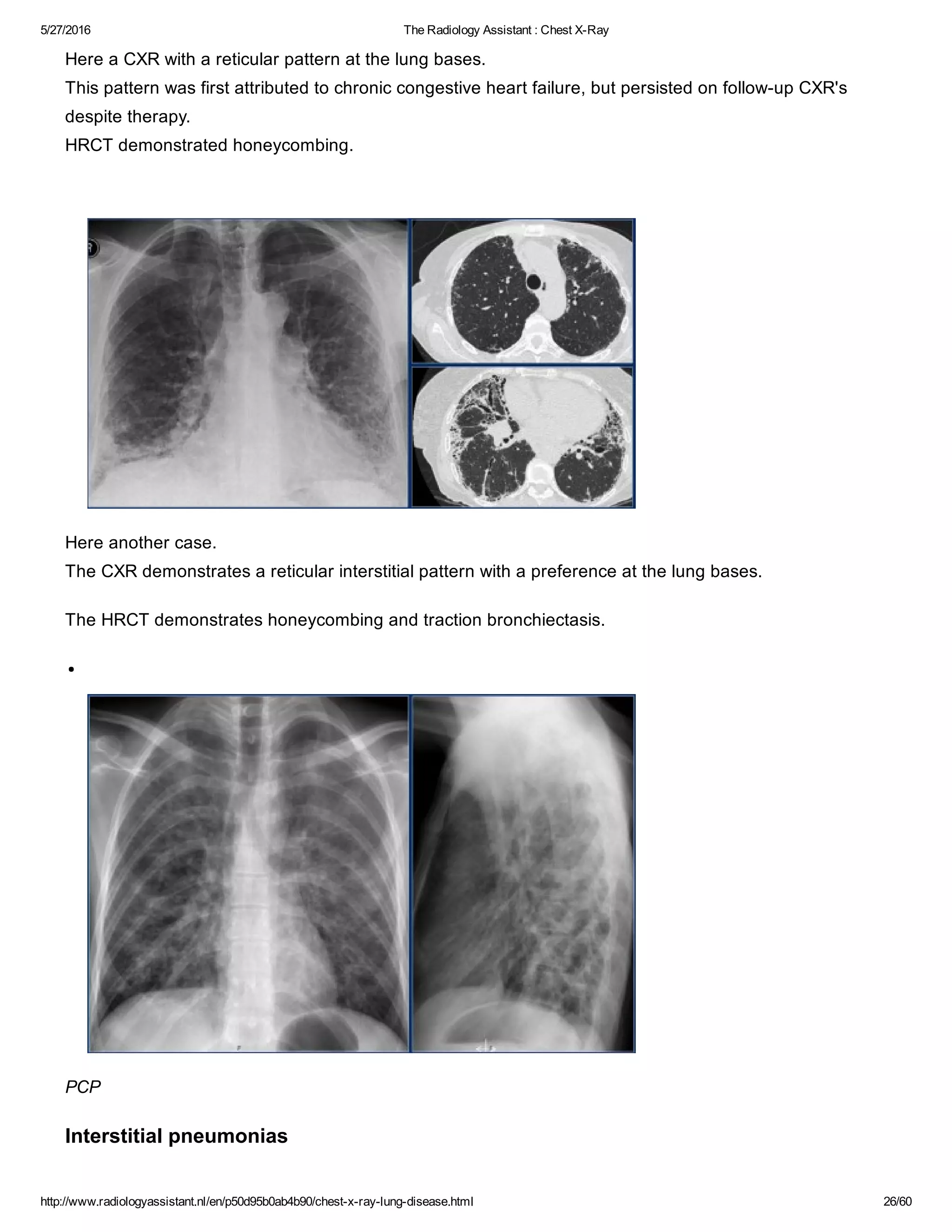 The radiology assistant chest x ray - lung disease | PDF
