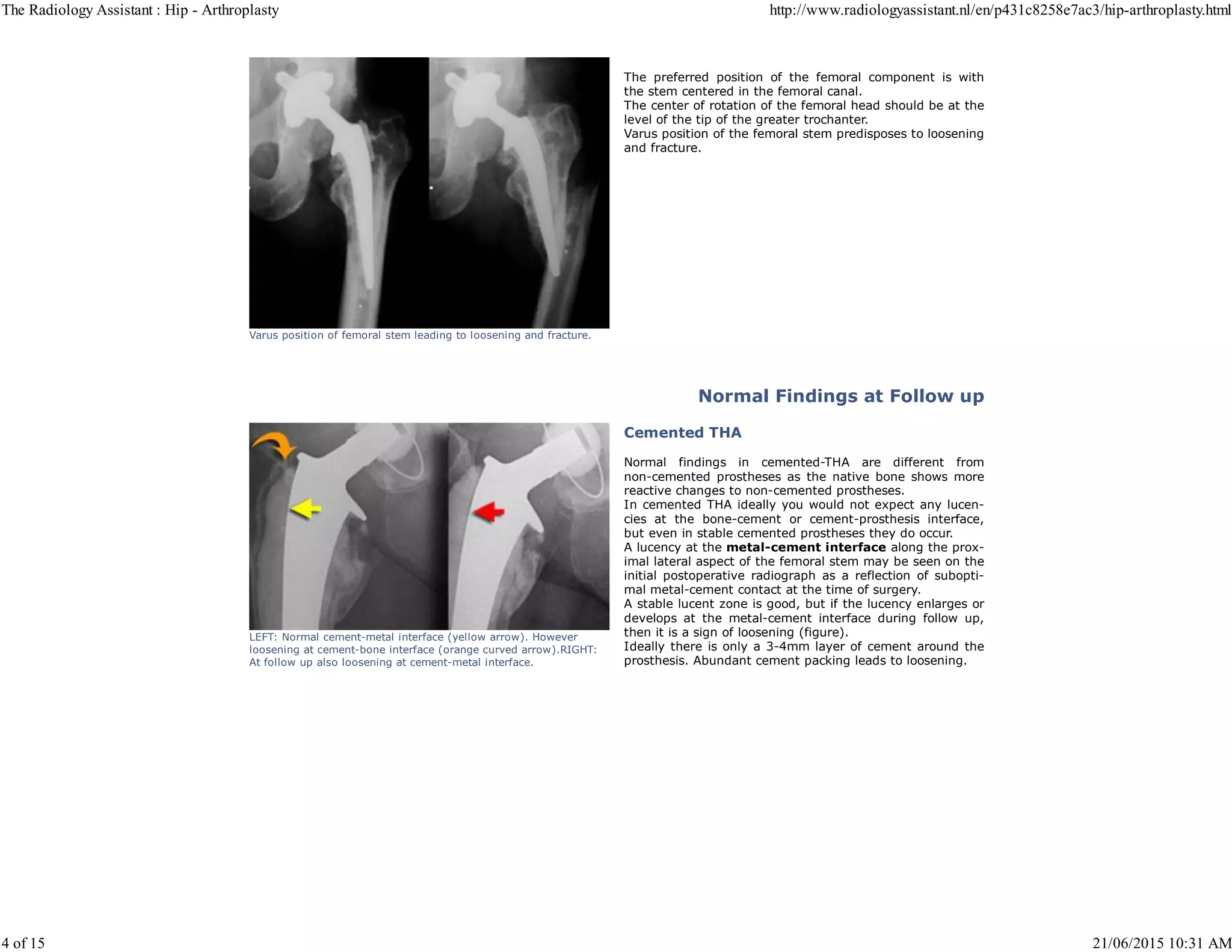 The radiology assistant hip arthroplasty | PDF