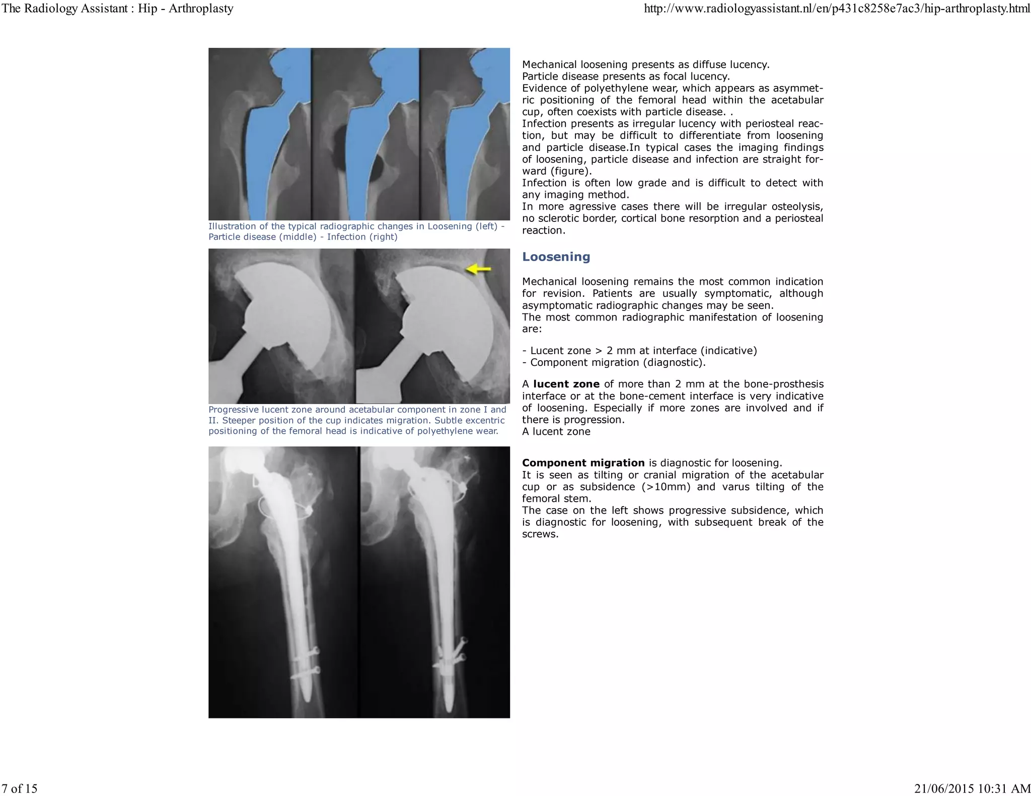 The radiology assistant hip arthroplasty | PDF