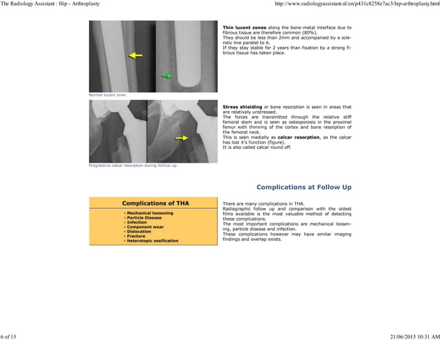 The radiology assistant hip arthroplasty | PDF